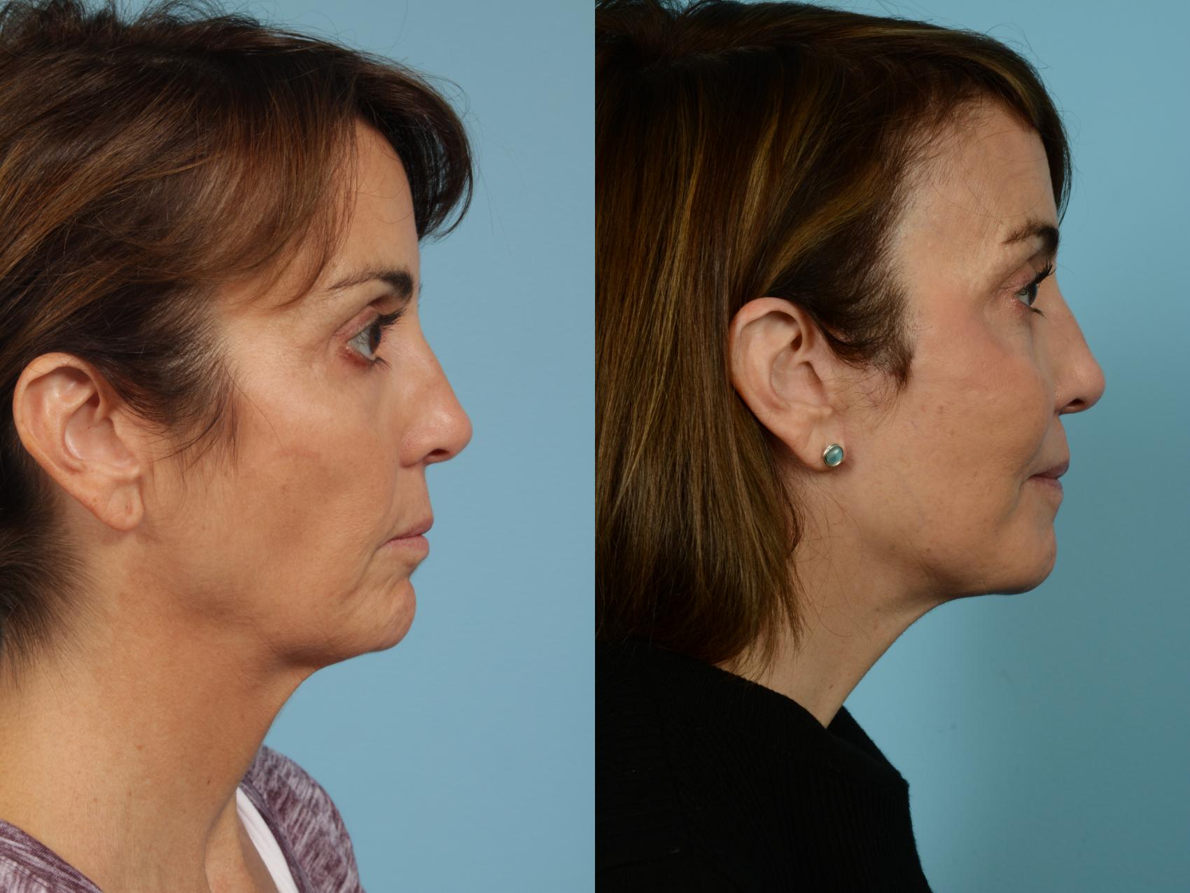 What Is the Best Age for a Mini Facelift? It May Be Younger Than You ...