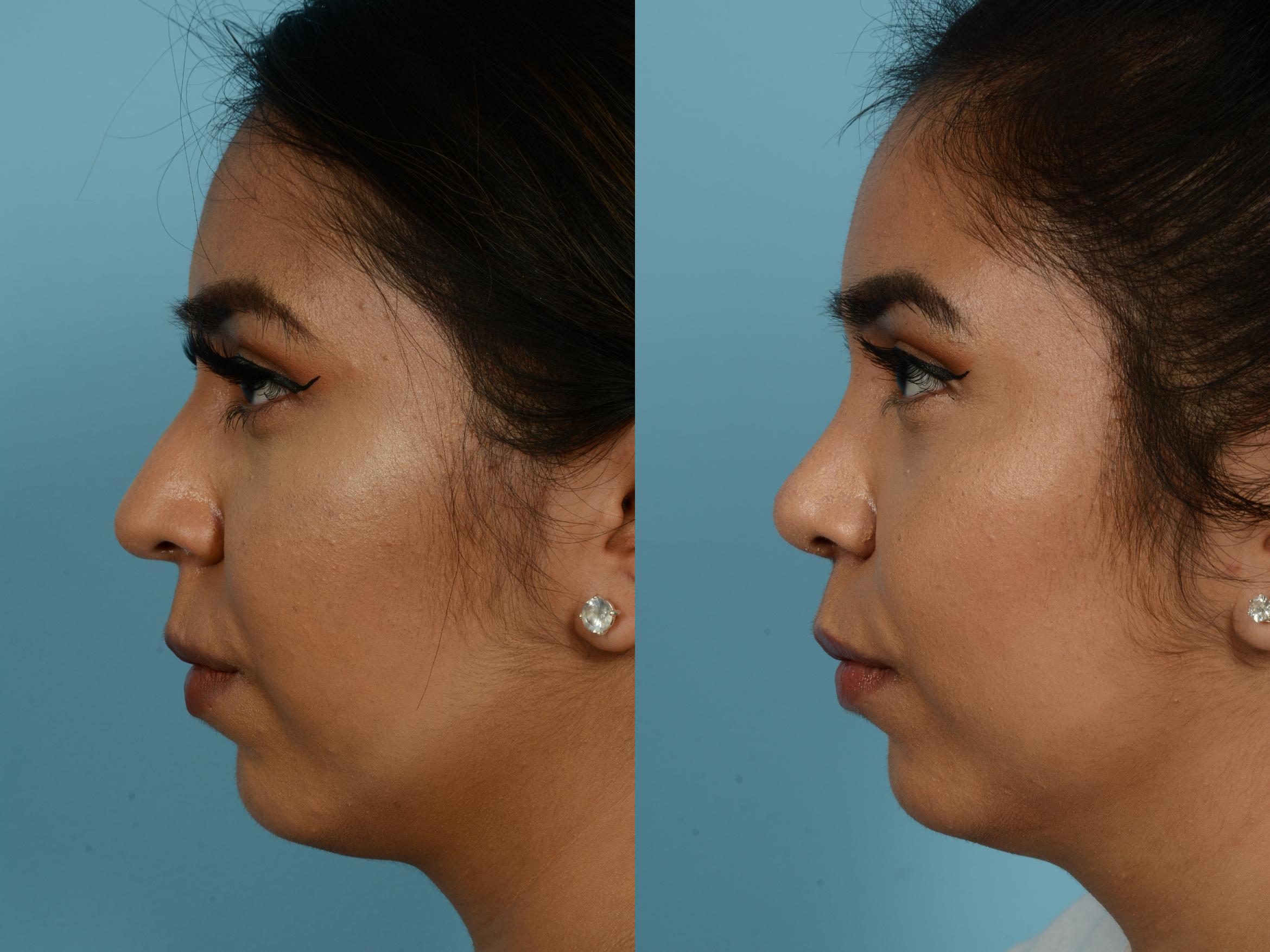 Rhinoplasty by Dr. Sinno Before and After Pictures Case 673 | Chicago ...