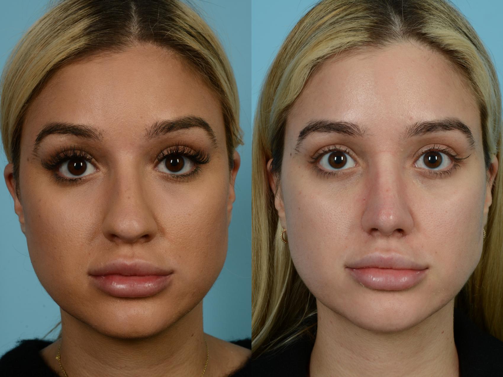 Rhinoplasty by Dr. Sinno Before and After Pictures Case 676 | Chicago ...