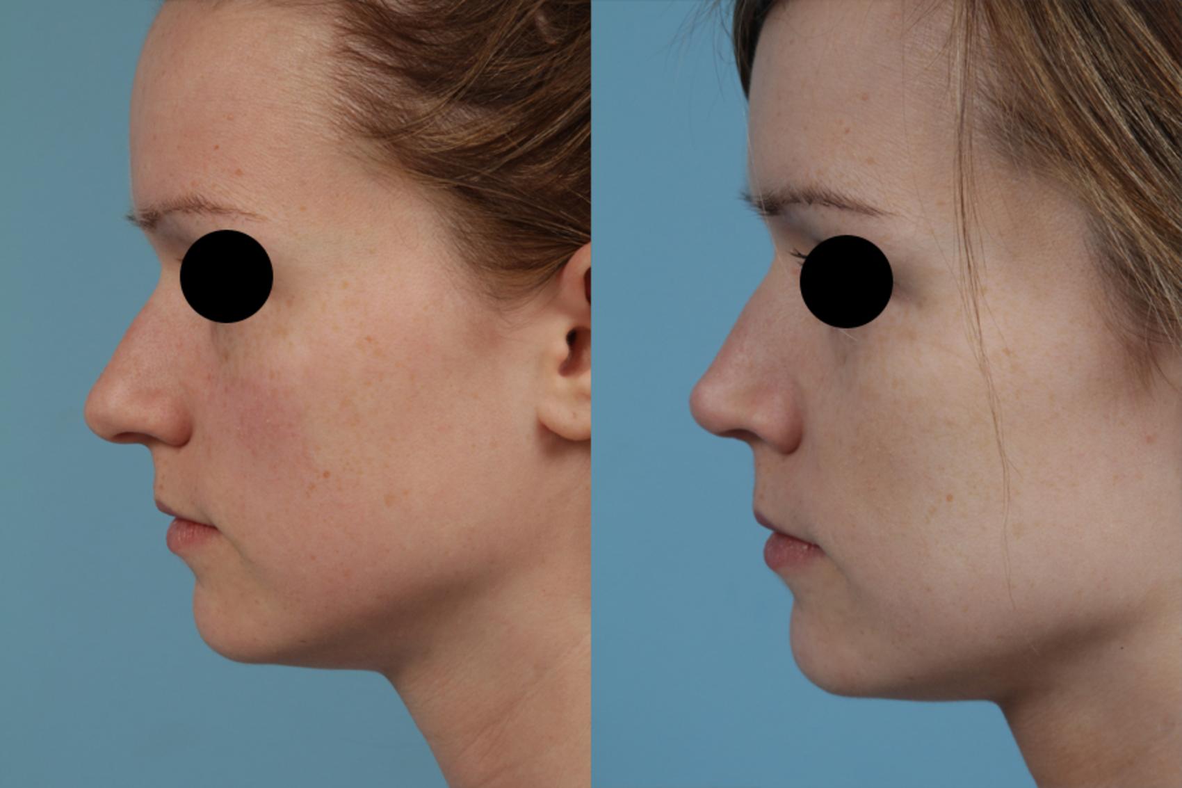 Rhinoplasty by Dr. Mustoe Before & After Photo Gallery | Chicago, IL ...