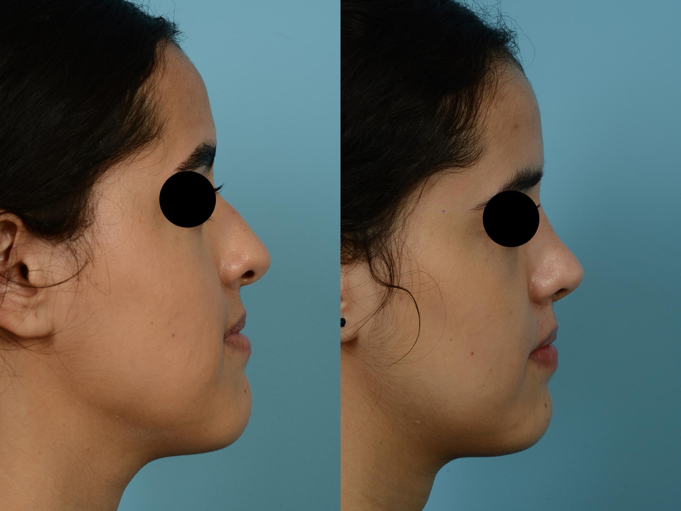 Rhinoplasty by Dr. Sinno Before & After Photo Gallery | Chicago, IL ...